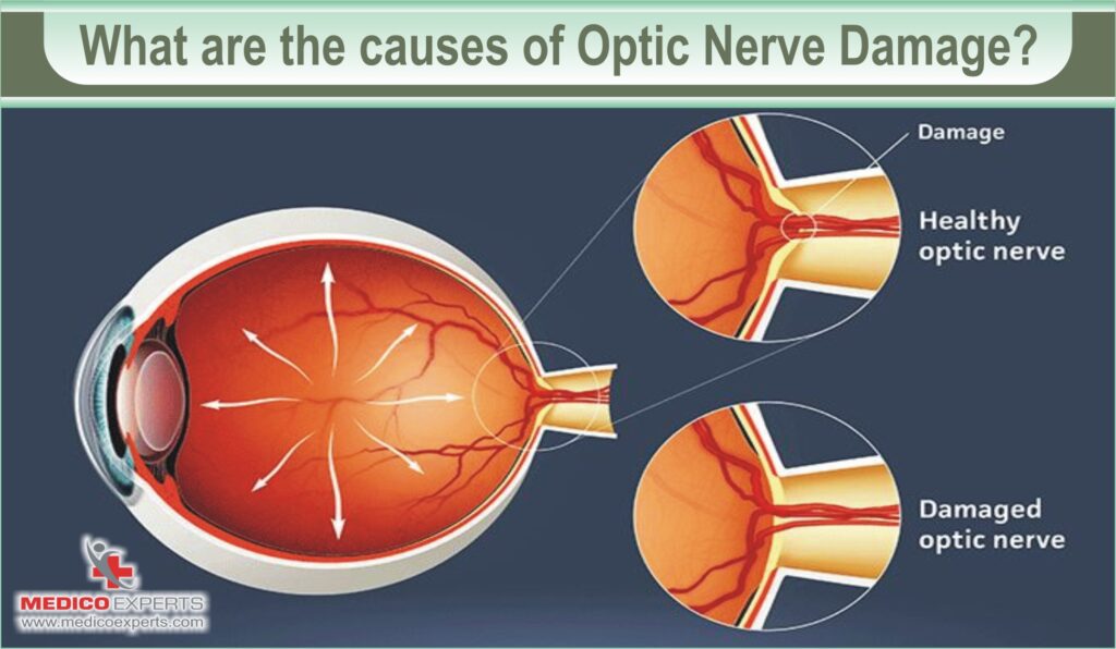Optic Nerve Regeneration: A New Frontier in Vision Restoration
